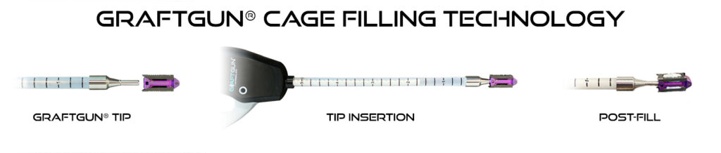 Bone Graft Delivery | SurGenTec Graftgun®