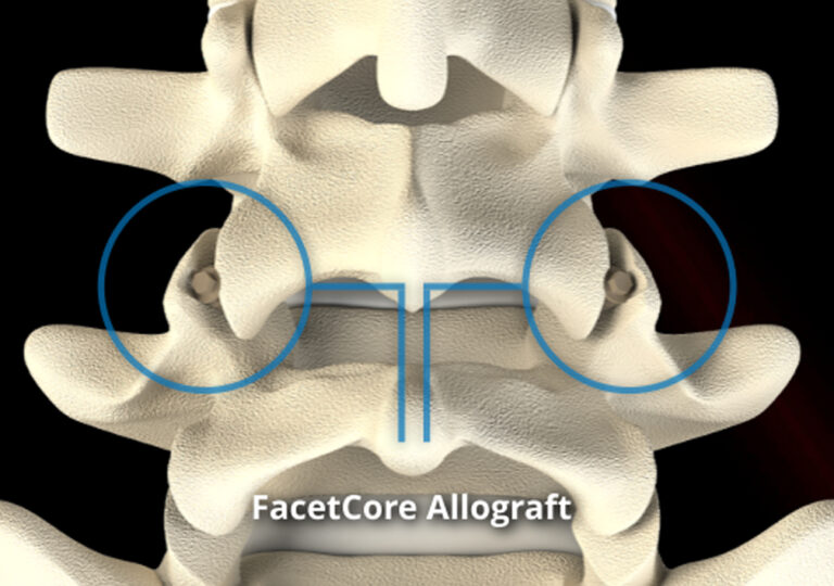 FacetCore™ | SurGenTec