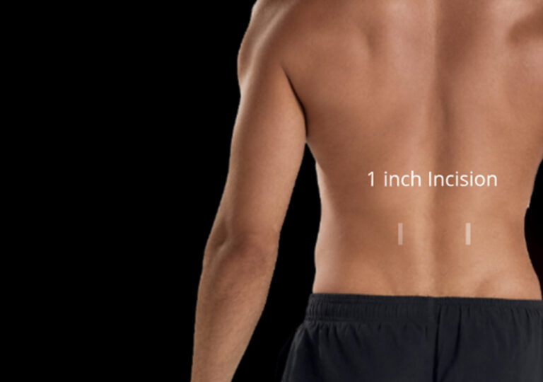 FacetCore™ | SurGenTec