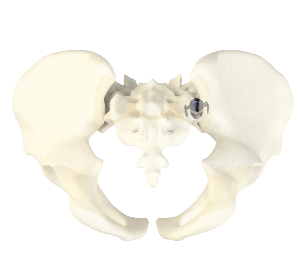 TILINK-P: SI Fusion Implant System