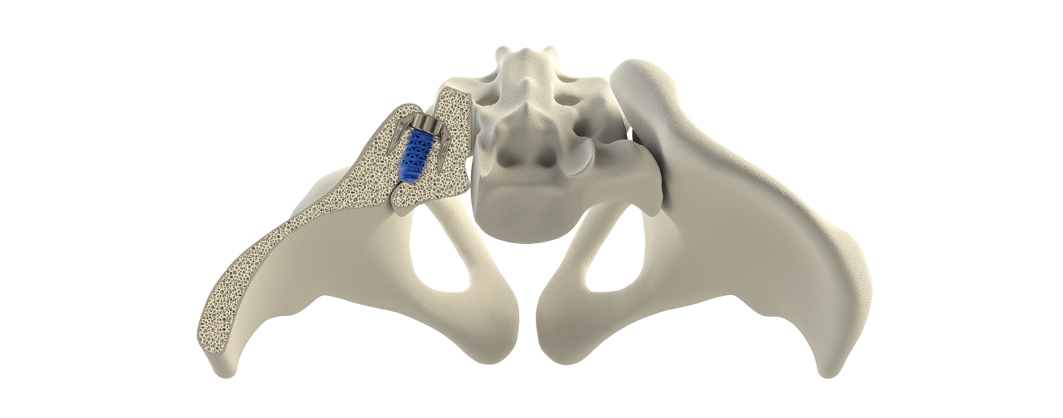TILINK-P: SI Fusion Implant System