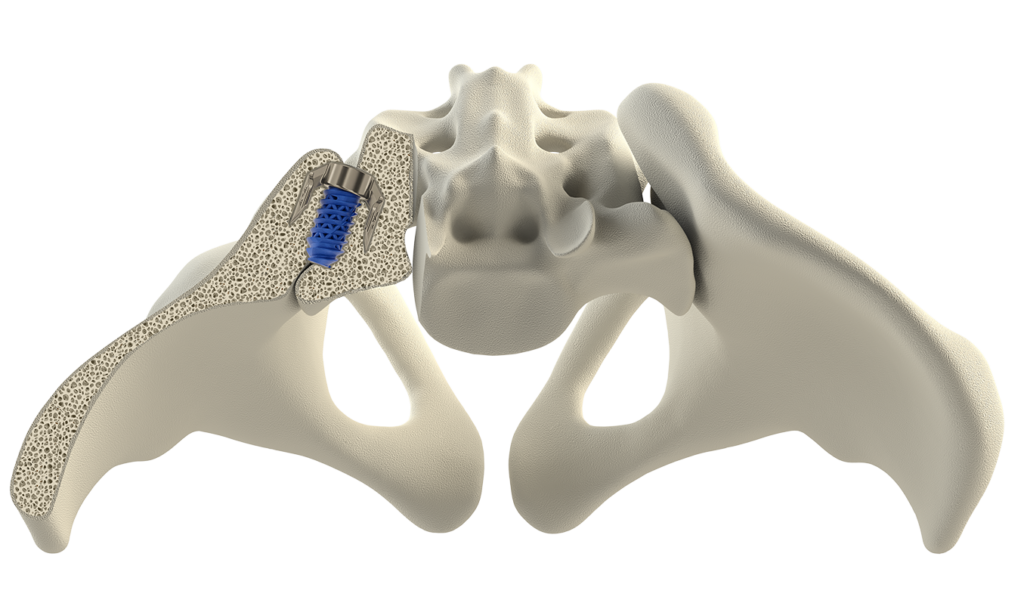 TILINK-P: SI Fusion Implant System