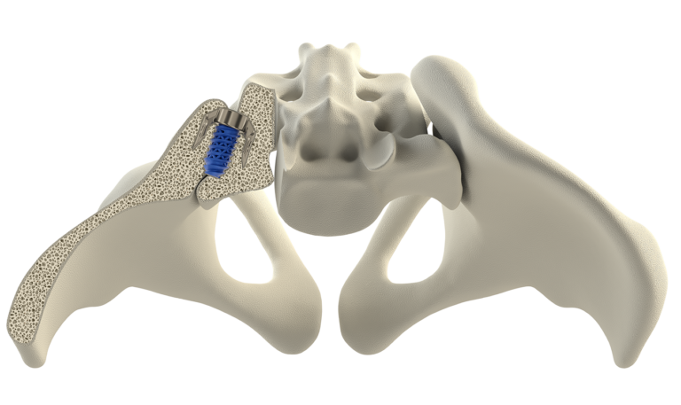 TILINK-P: SI Fusion Implant System