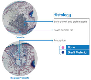 Synthetic Bone Graft Putty | OsteoFlo® NanoPutty®