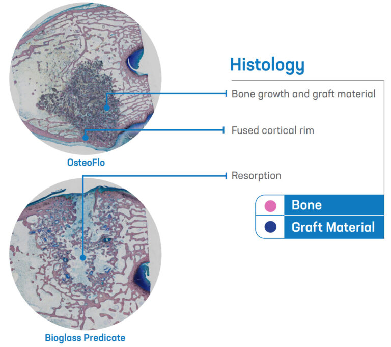 Synthetic Bone Graft Putty | OsteoFlo® NanoPutty®