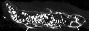 OsteoFlo® HydroFiber™ - SurGenTec Graftgun®