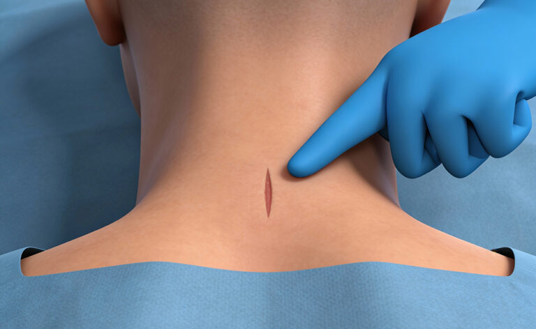 ION-C™ - Cervical Facet Implant | SurGenTec