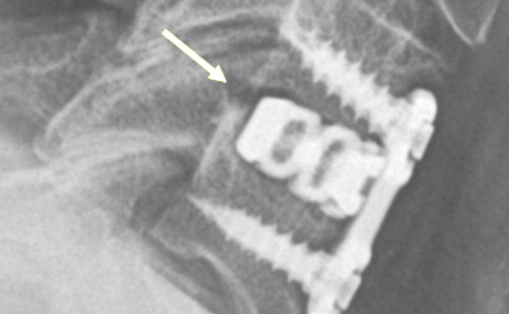 ION-C™ - Cervical Facet Implant | SurGenTec
